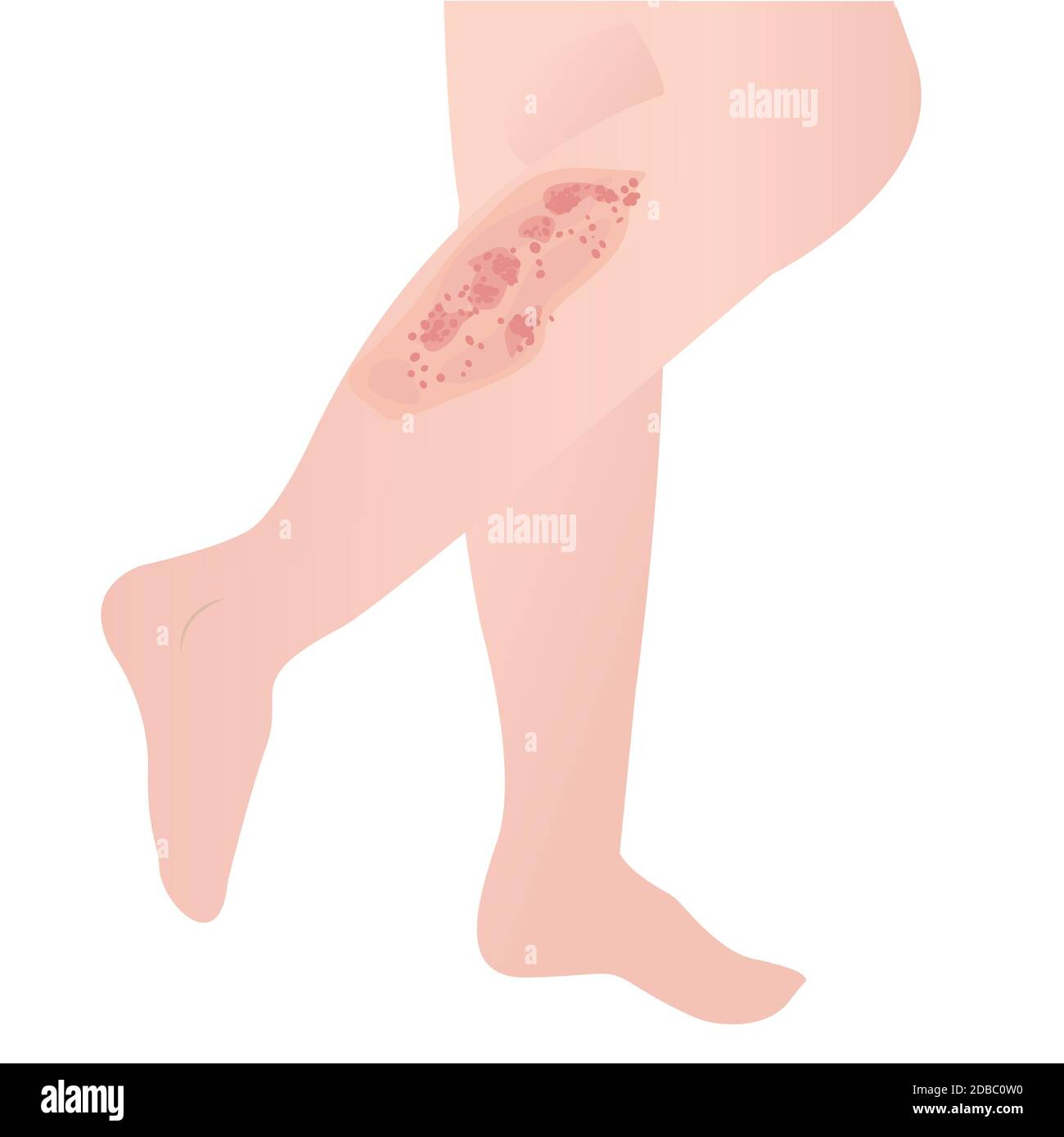 psoriasis skin disease on a white background vector illustration Stock ...