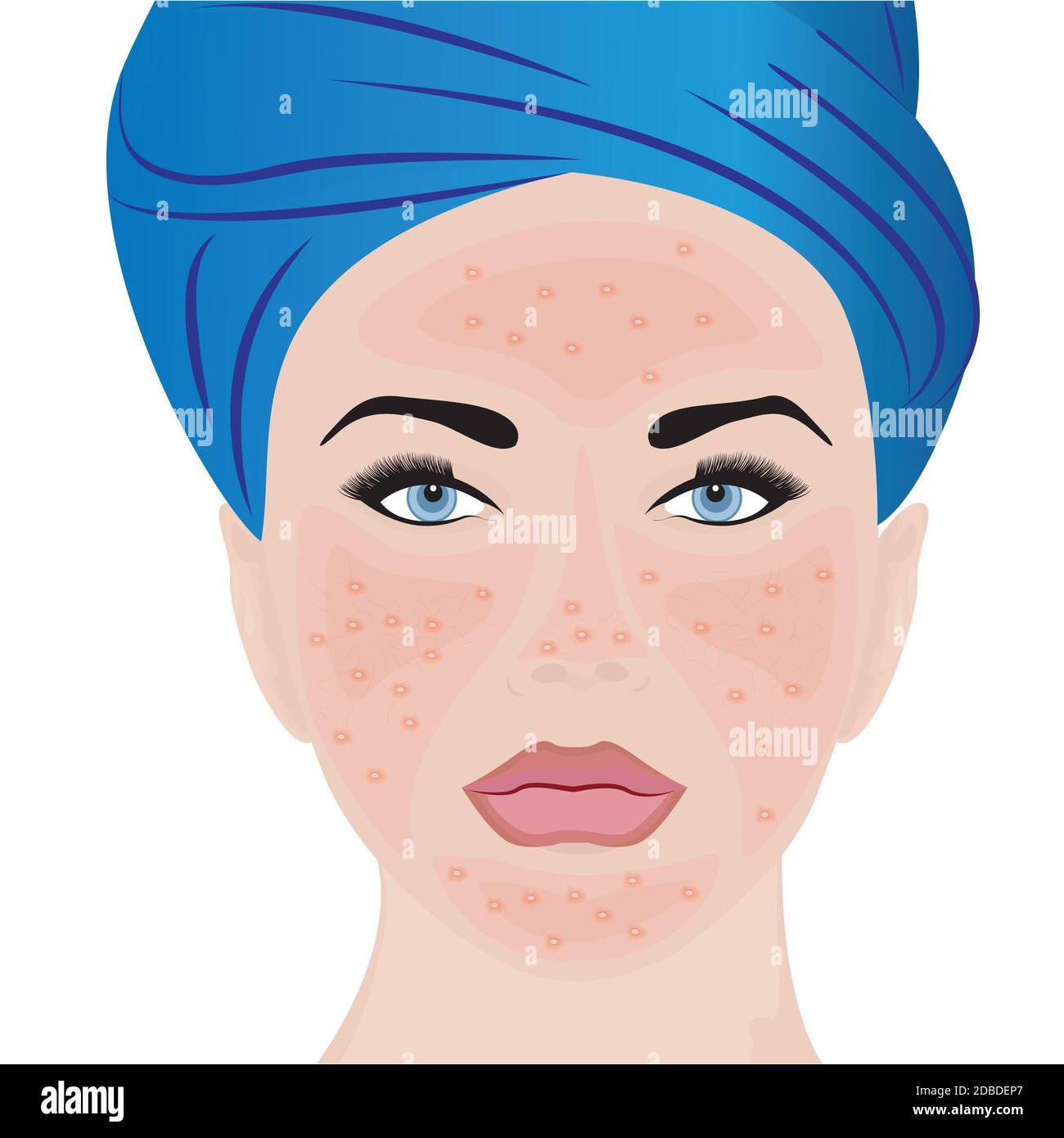 Rosacea moderate on a woman face vector illustration Stock Photo - Alamy