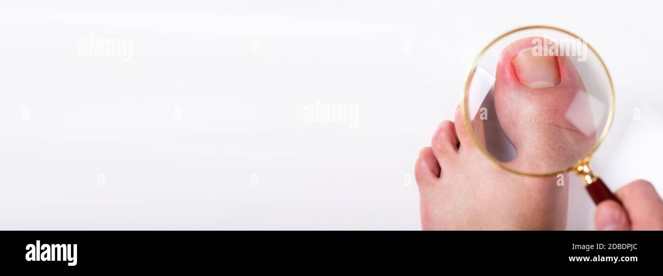 Ingrown Toenail. Infected And Sore Nail Problem Magnifying Glass Stock ...