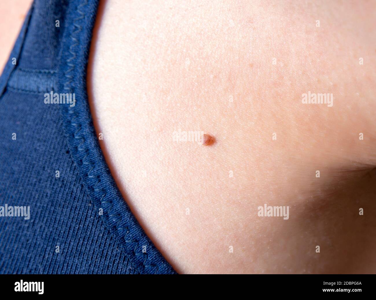 Closeup of the mole on female body Stock Photo - Alamy