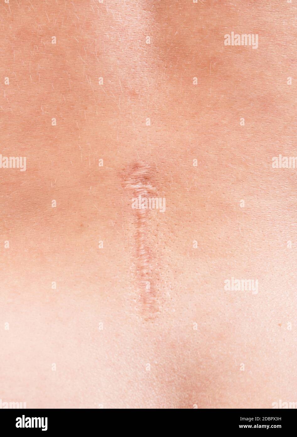 Scar on the female back after the spine surgery Stock Photo - Alamy