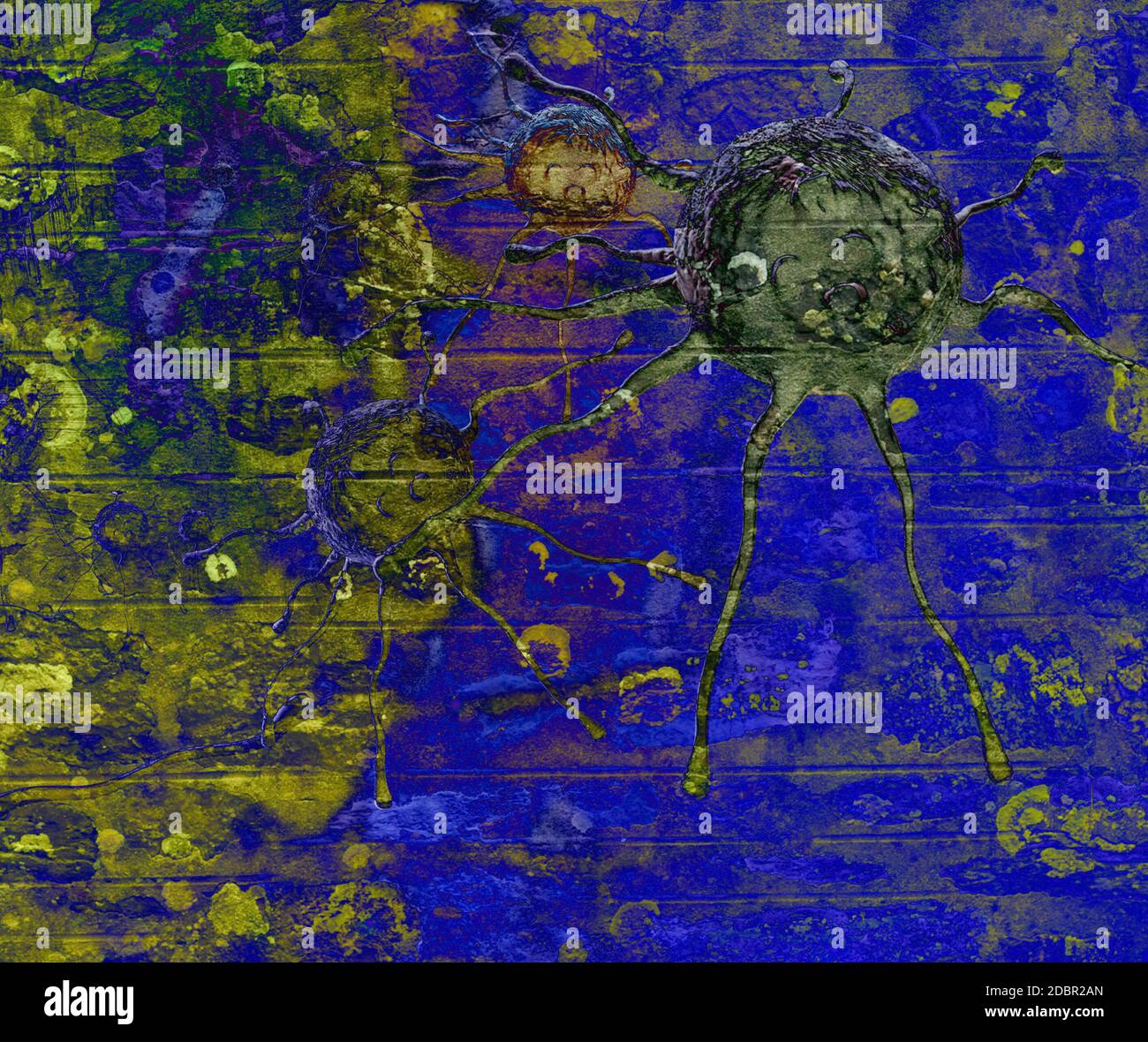 Digital 3d illustration of cancer cells in human body Stock Photo - Alamy