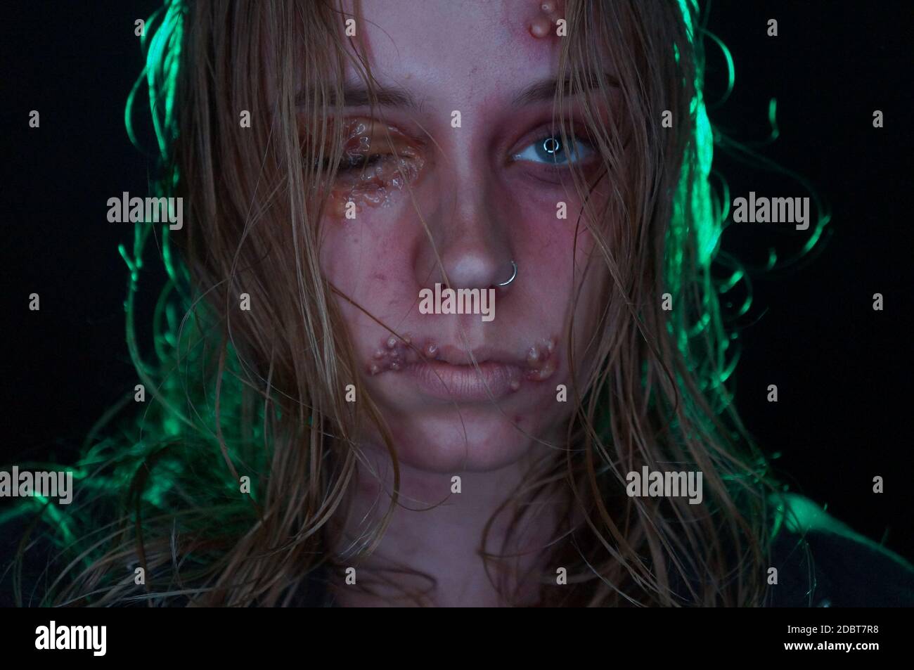 Burn blister woman hi-res stock photography and images - Alamy