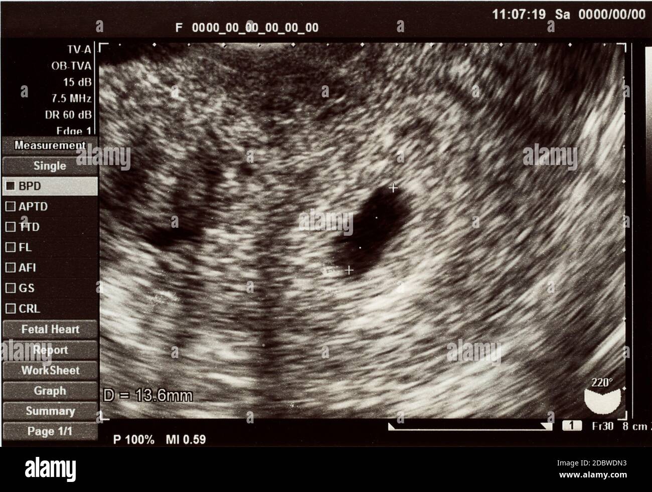 Fetal ultrasound hi-res stock photography and images - Alamy