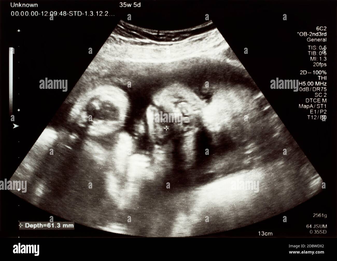 Fetal Ultrasound Scan Stock Photo - Alamy