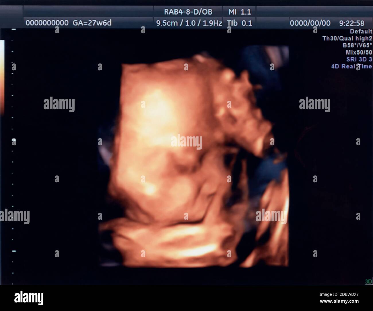 Fetal Ultrasound Scan Stock Photo - Alamy
