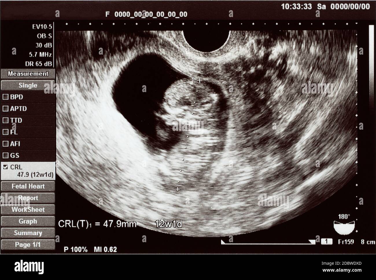 Fetal Ultrasound Scan Stock Photo - Alamy