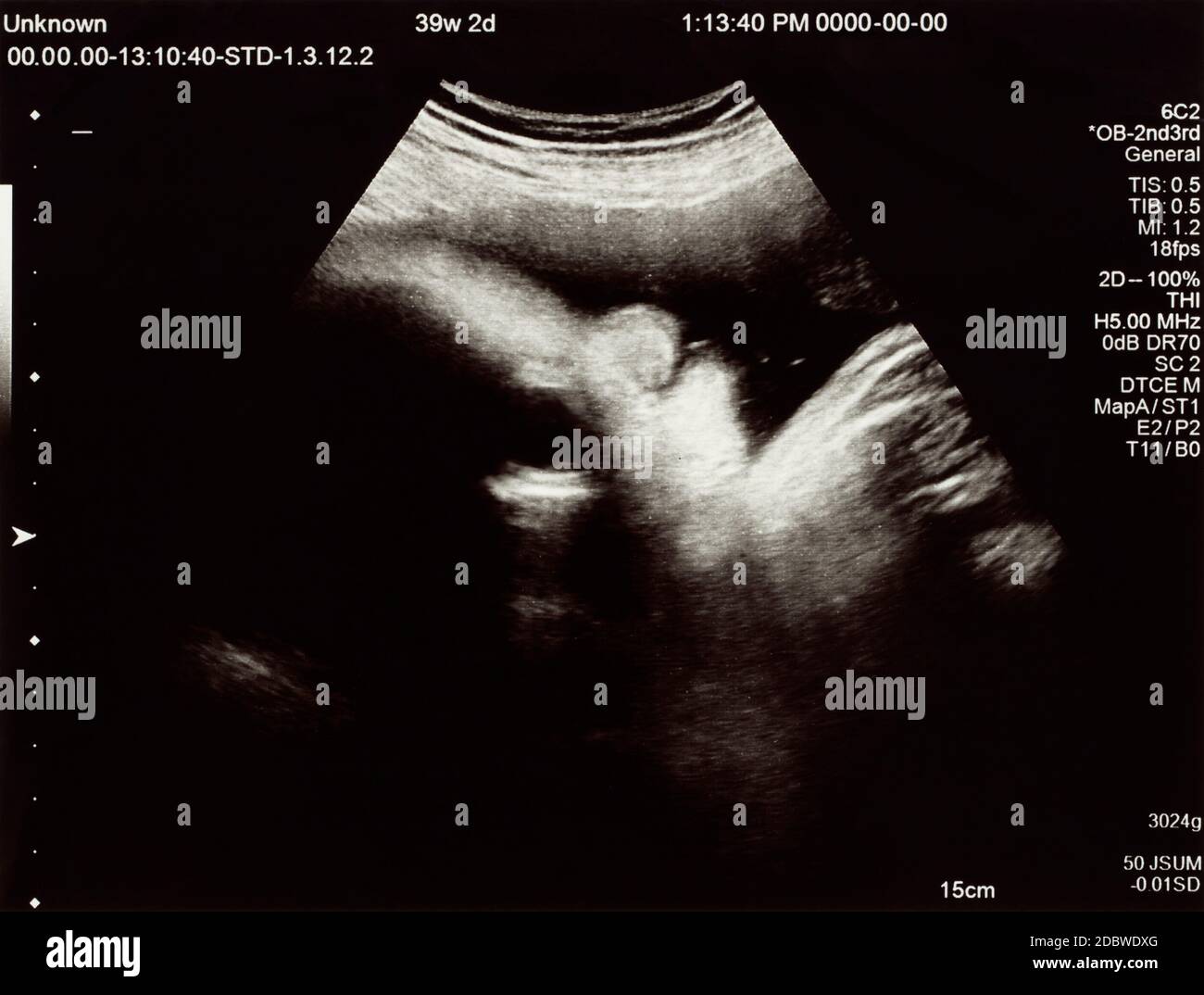 Fetal ultrasound hi-res stock photography and images - Alamy