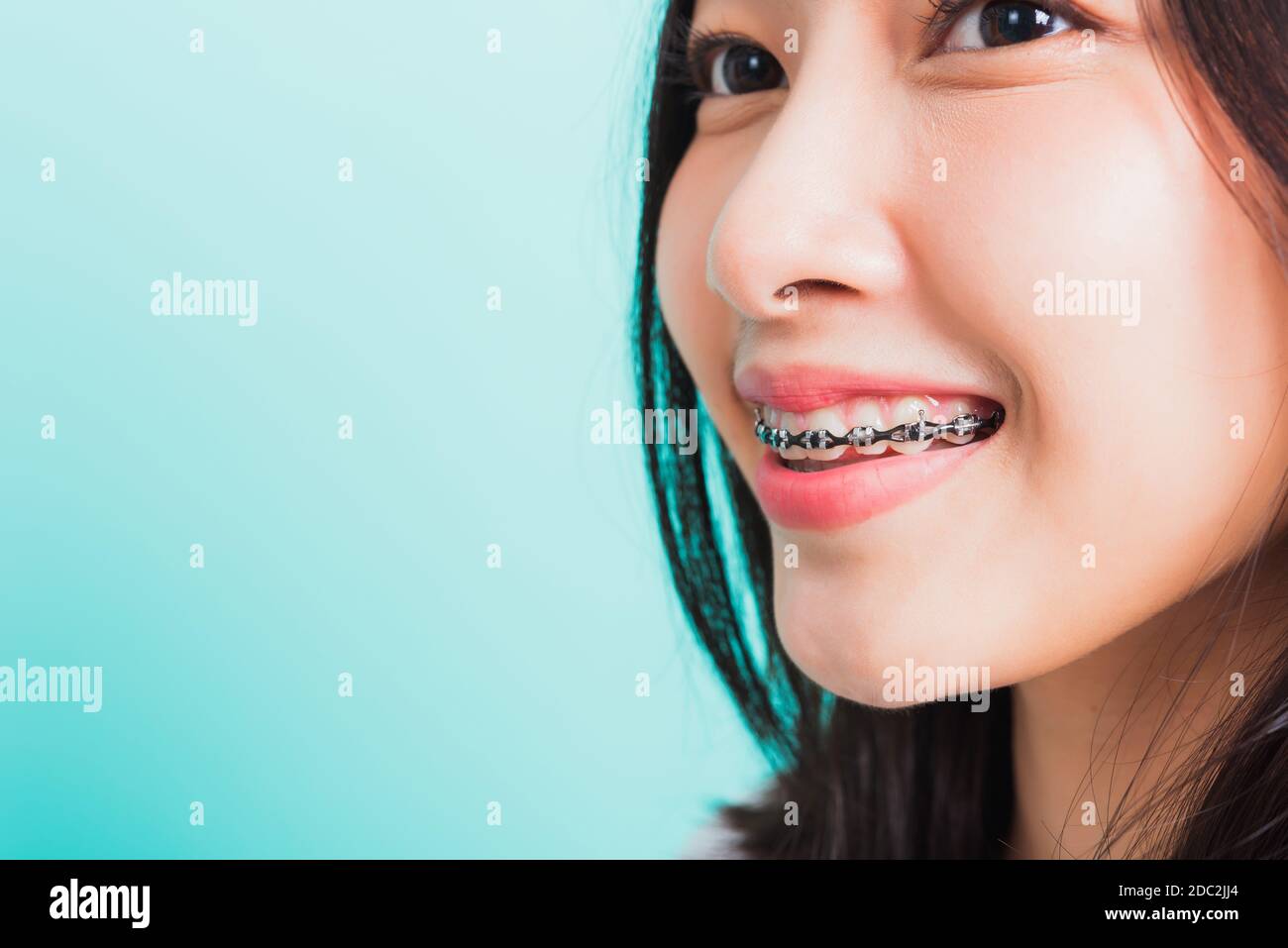 Asian teen girl brace hi-res stock photography and images - Alamy