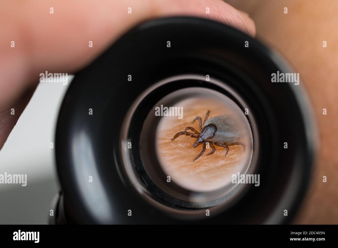 Deer tick on human skin in magnifying glass of black eyepiece. Ixodes ...