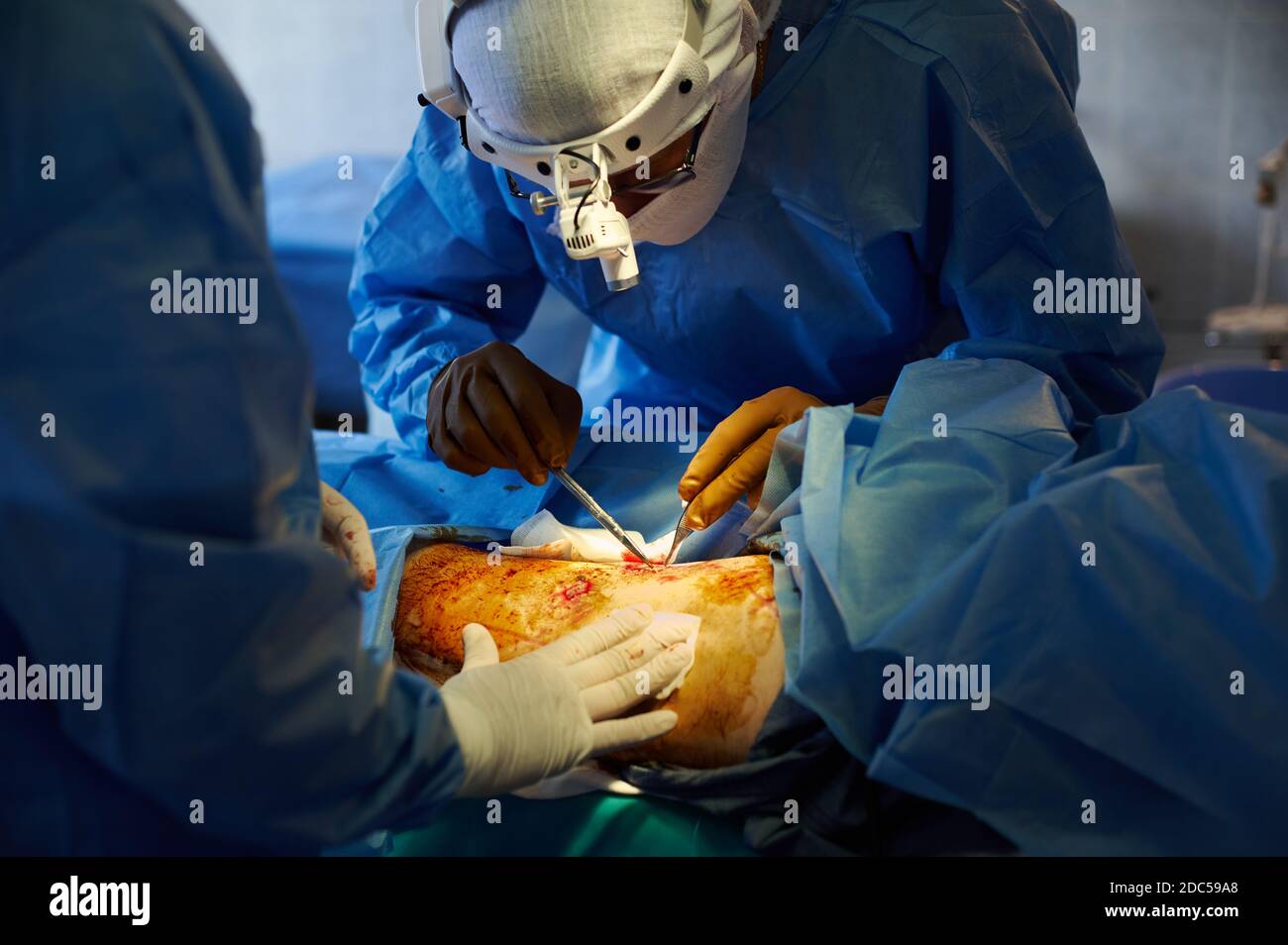 Surgery. Surgeon performs the intervention using metal instruments ...