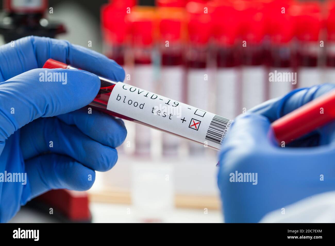 Lab scientist medical technologist labelling blood sample test tube ...