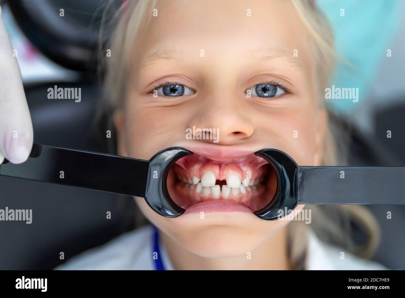 Little blond kid girl at dentist office showing malocclusion and ...