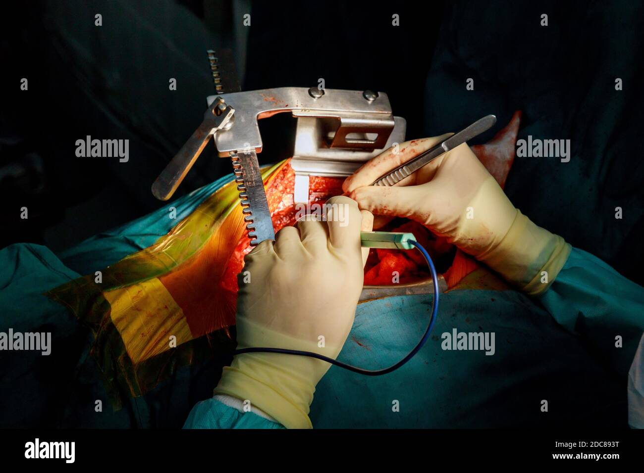 Teamwork surgeons during open heart surgery doctor holding surgical ...