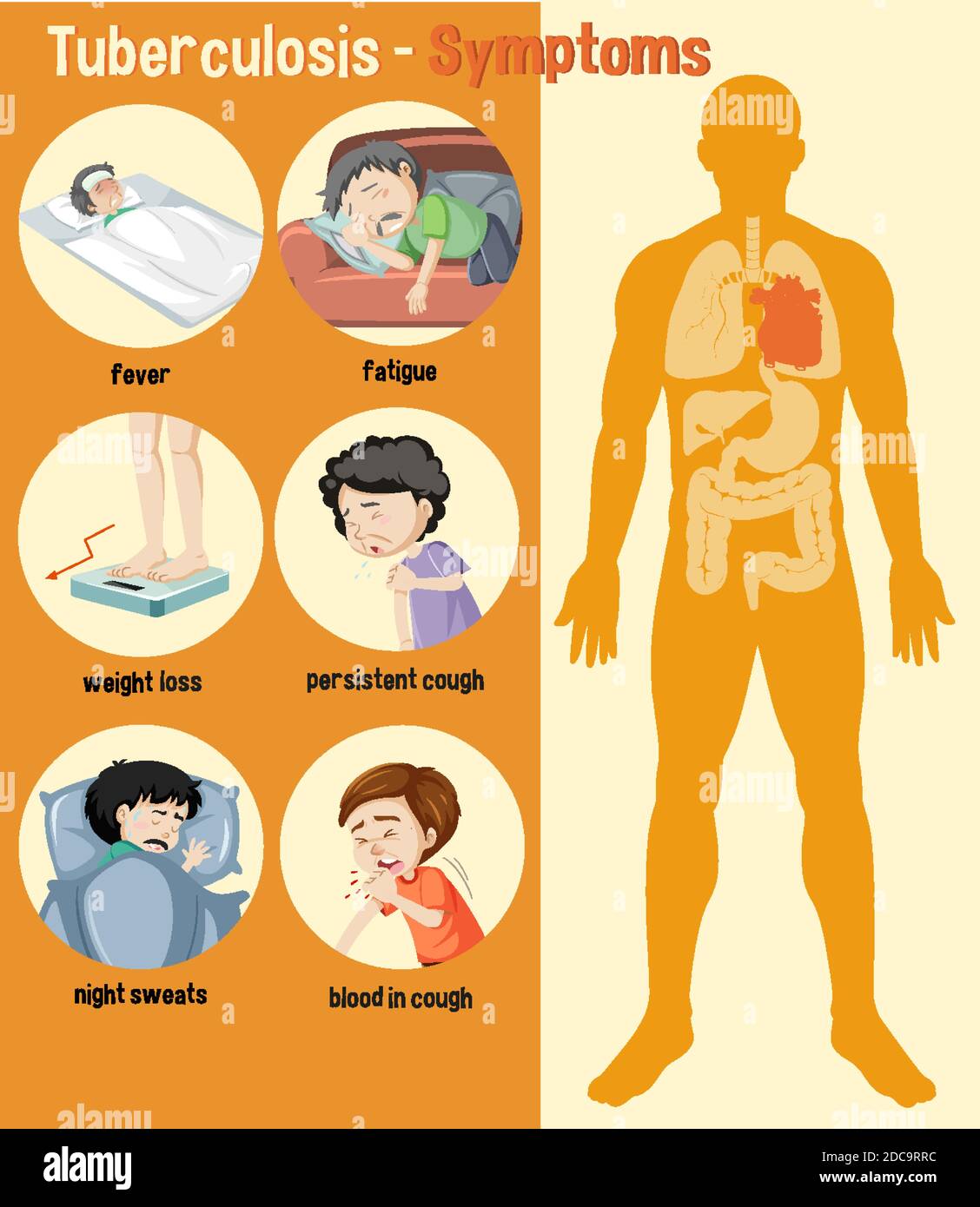 Tuberculosis Symptoms Information Infographic illustration Stock Vector ...