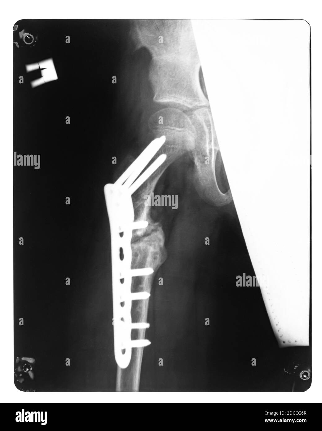x-ray film broken bone at hip install plate with screw Stock Photo - Alamy