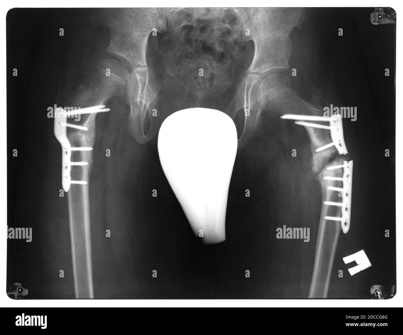 Broken hip bone xray hi-res stock photography and images - Alamy