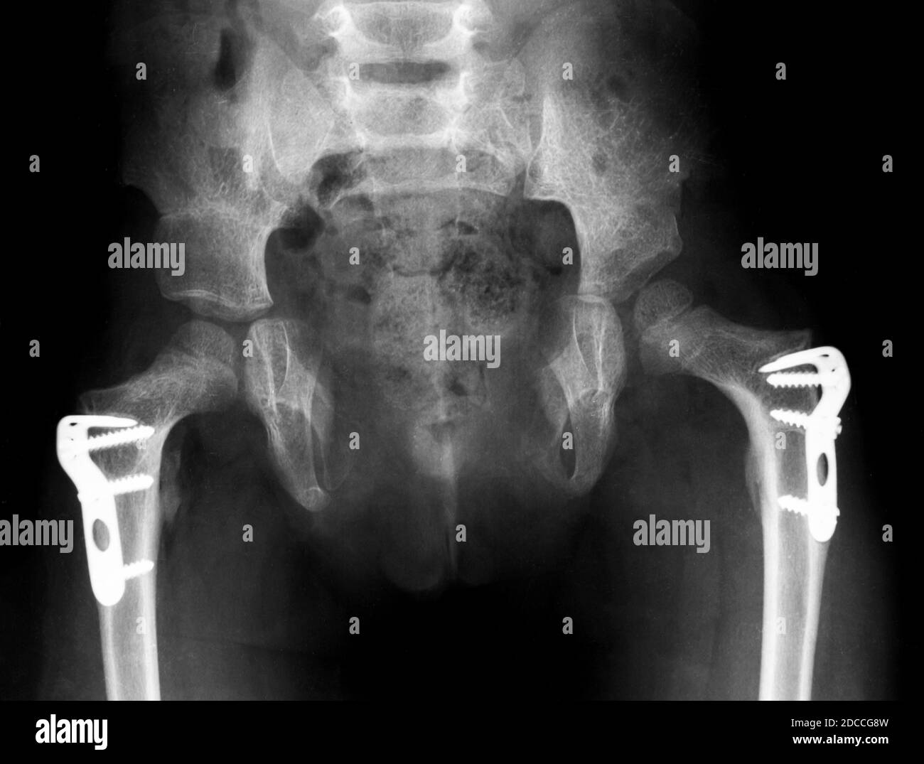 Broken Hip Bone High Resolution Stock Photography and Images - Alamy
