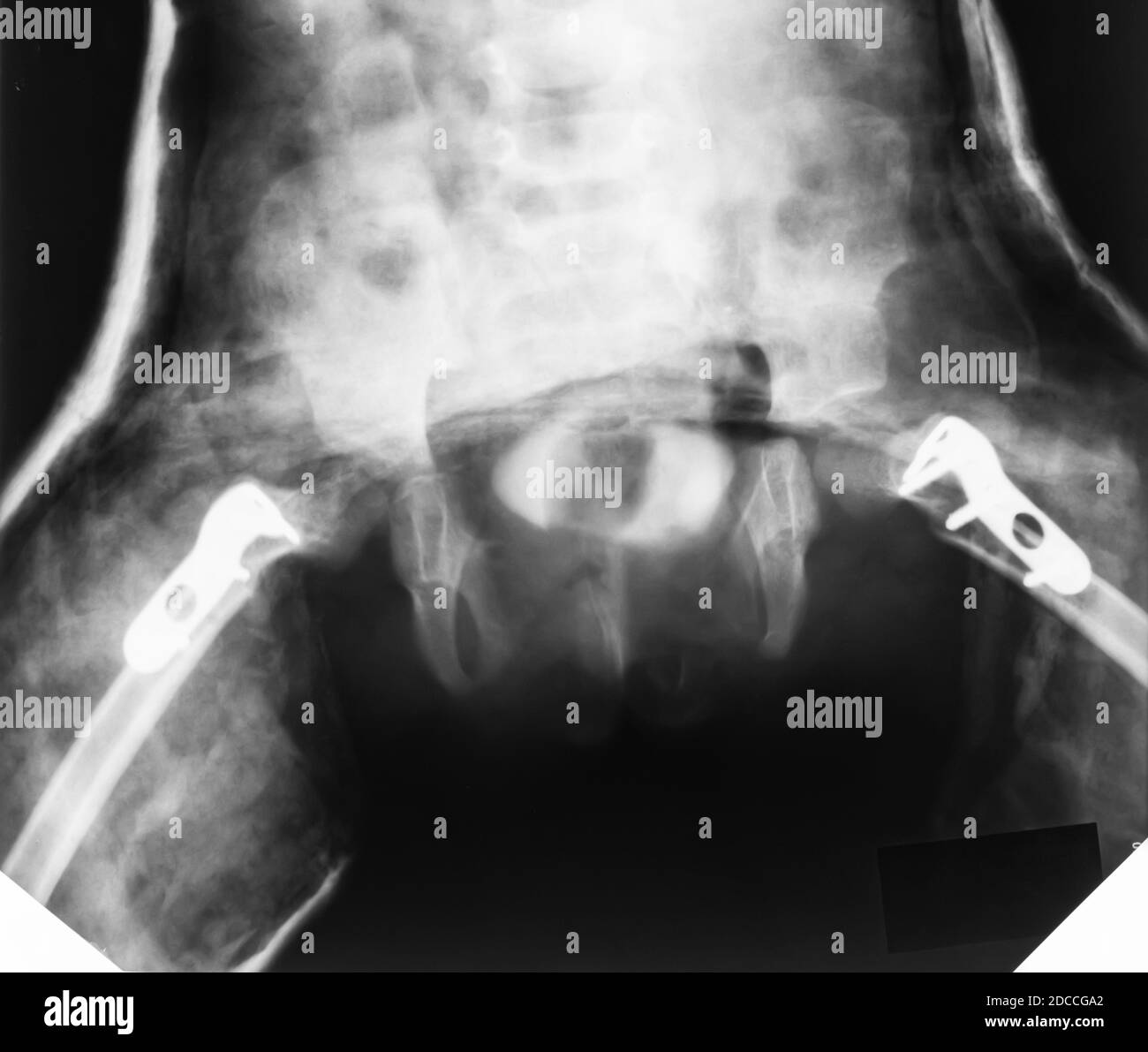 Broken hip bone xray hi-res stock photography and images - Alamy