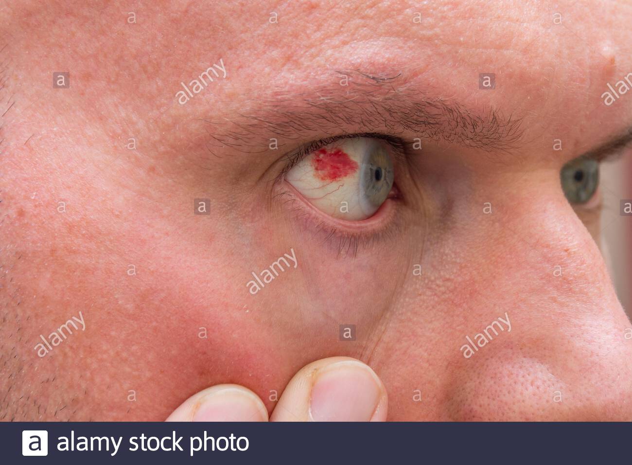 Hemorrhage High Resolution Stock Photography and Images - Alamy