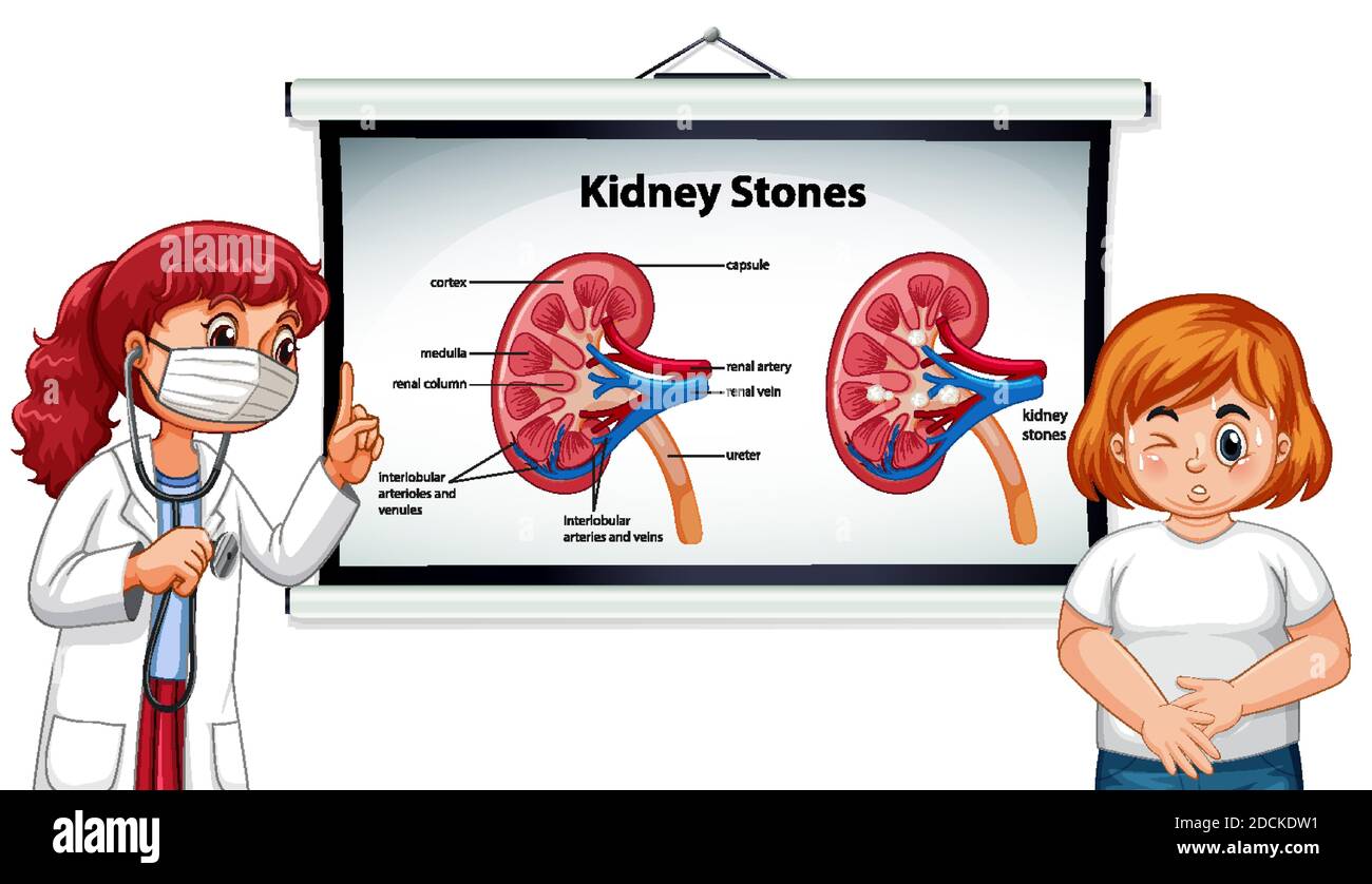 Kidney stones symptoms cartoon style infographic with doctor cartoon ...