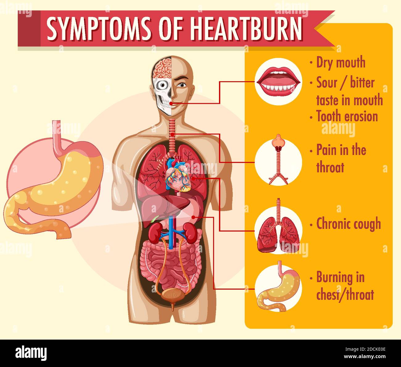 Symptoms of heartburn information infographic illustration Stock Vector ...