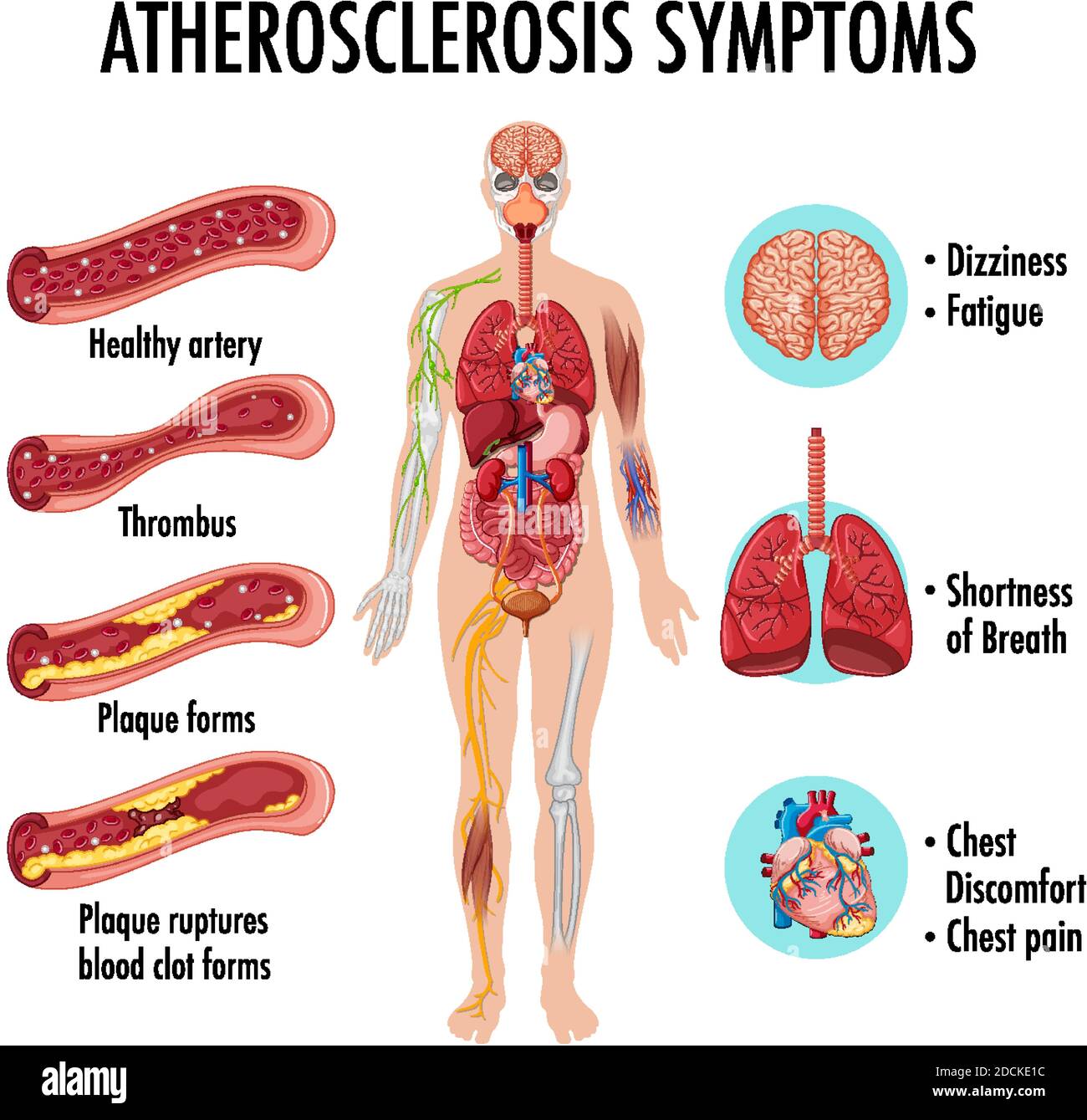 Stages of atherosclerosis information infographic illustration Stock ...