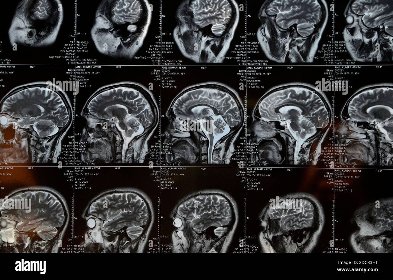 MRI Brain Scan of head and skull Stock Photo - Alamy