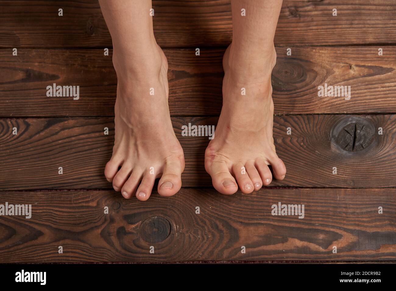 Hllux Valgus on female legs close up on wooden background. Foot joint ...