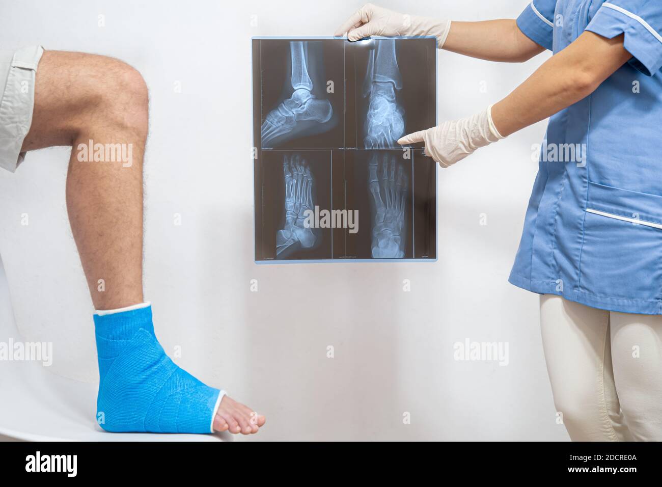 Female doctor in a blue medical gown checking broken leg and shows the ...