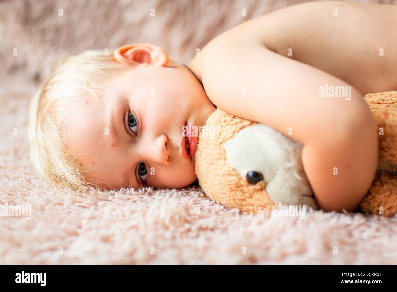 Little baby boy with Varicella virus or Chickenpox bubble rash at home ...