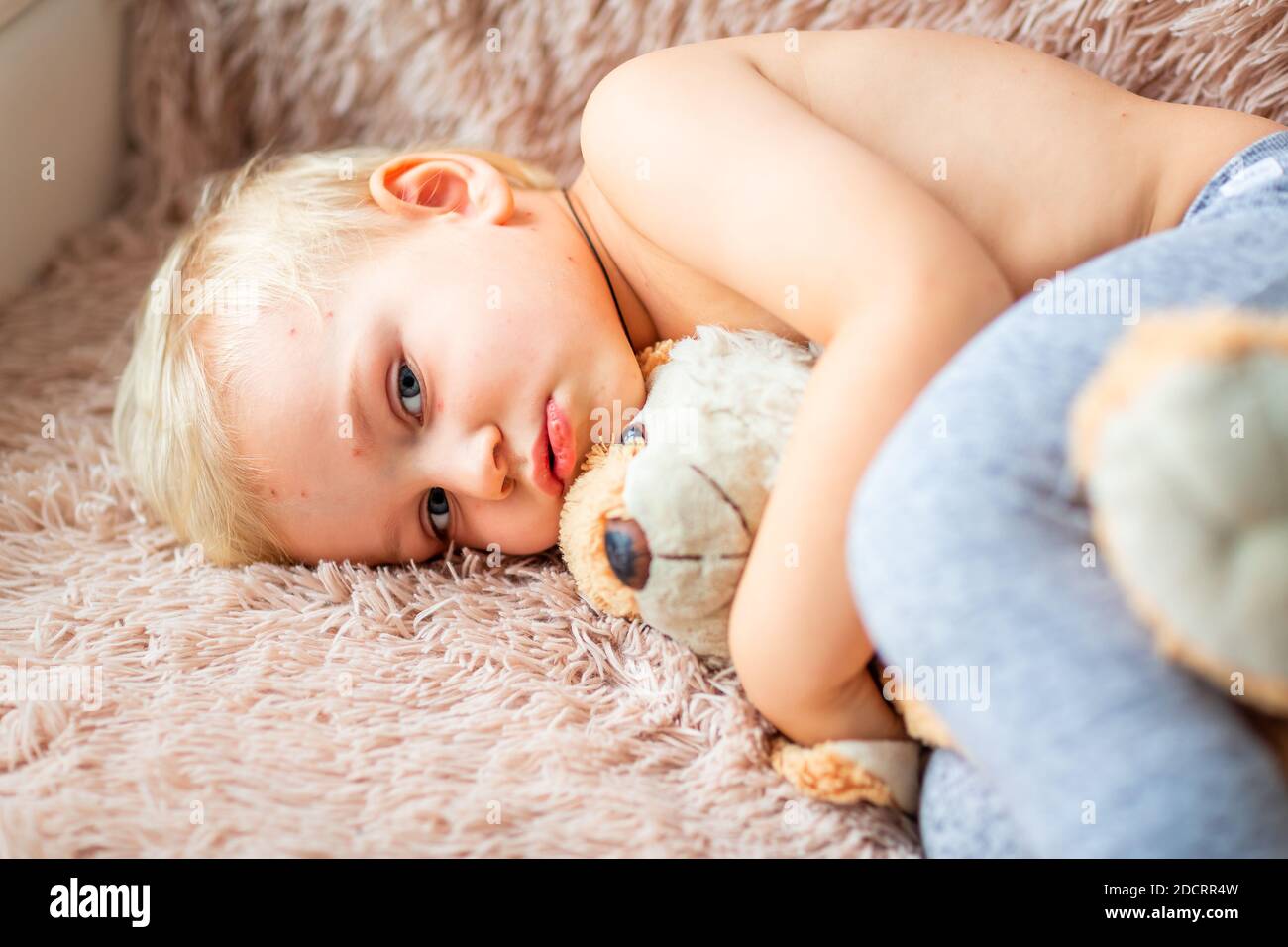 Little baby boy with Varicella virus or Chickenpox bubble rash at home ...