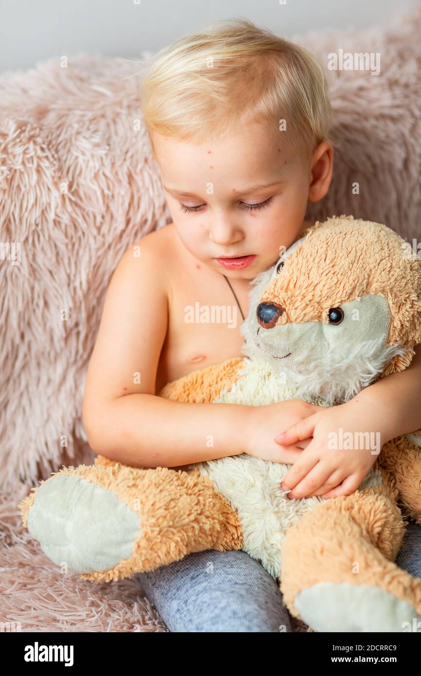 Little baby boy with Varicella virus or Chickenpox bubble rash at home ...