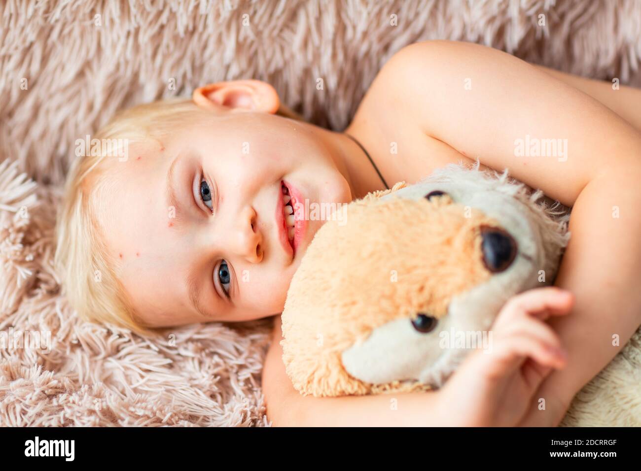 Little baby boy with Varicella virus or Chickenpox bubble rash at home ...