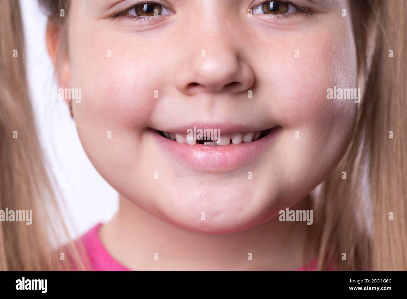 A preschool girl with her first adult incisors. The milk tooth has ...