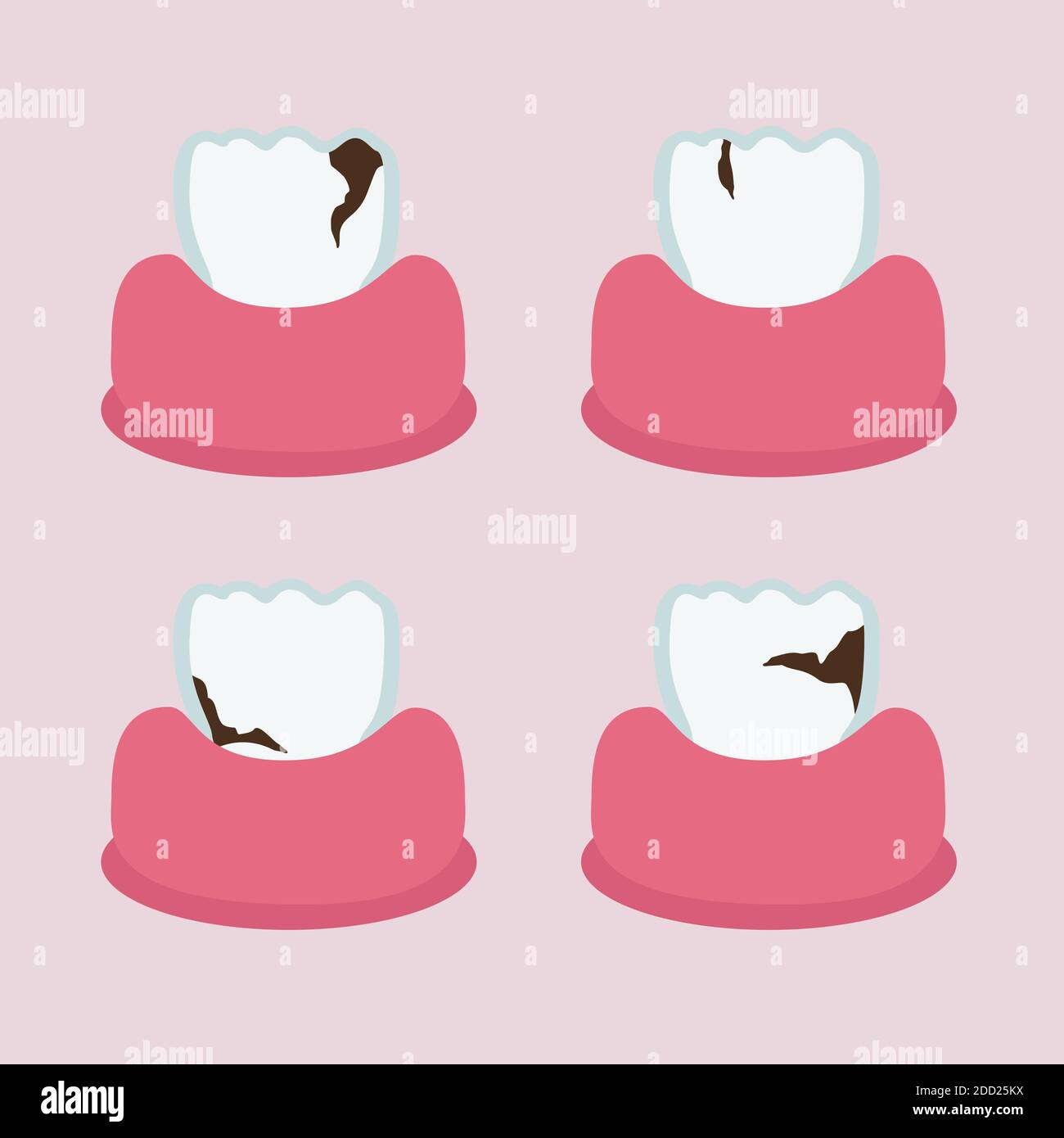 Teeth with cavities - vector illustration Stock Vector Image & Art - Alamy