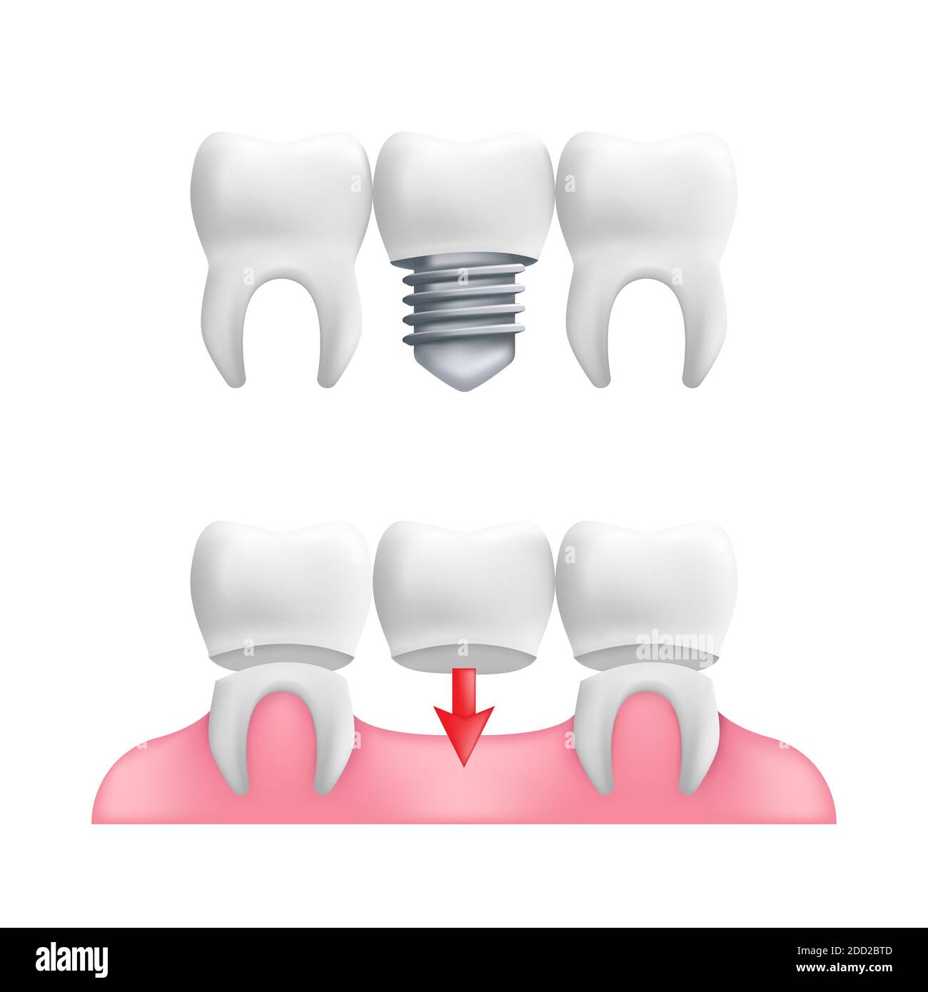 Denture concept - healthy teeth with fixed dental bridgework and ...