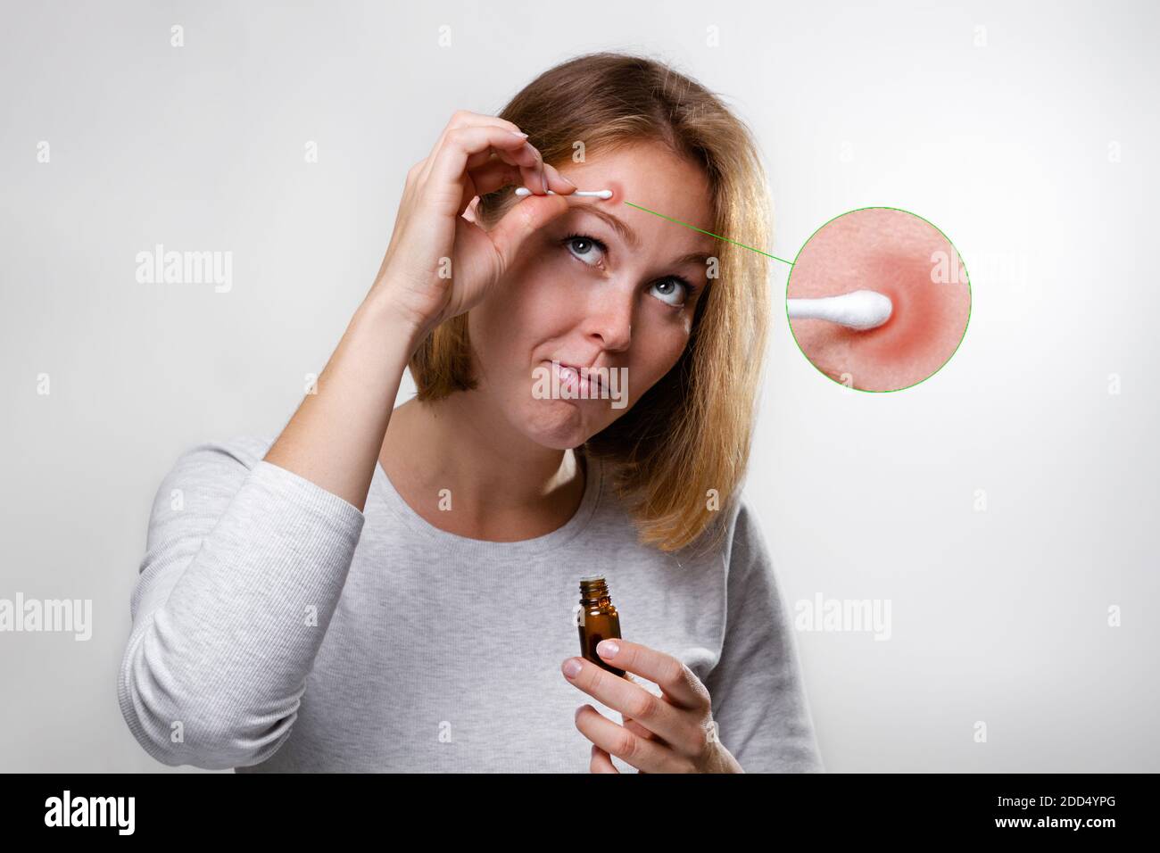 Cosmetology, dermatology and acne. A young blonde woman smears a pimple ...