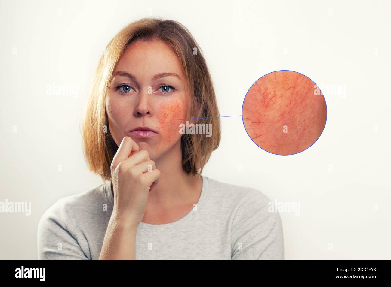 Medicine, cosmetology, rosacea. A blonde woman with rosacea-inflamed ...