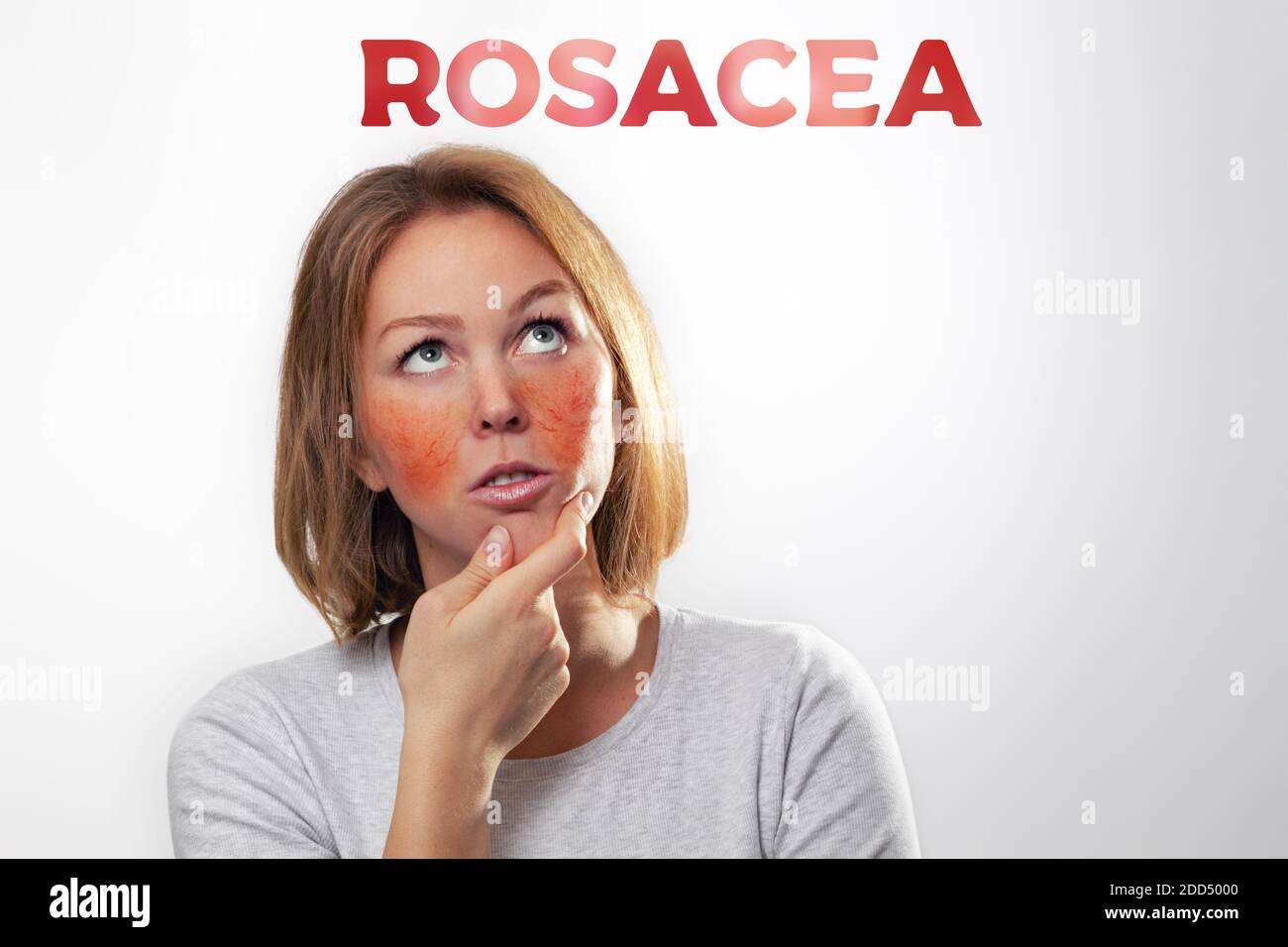 Medicine, cosmetology, rosacea. The woman is blonde with inflamed ...