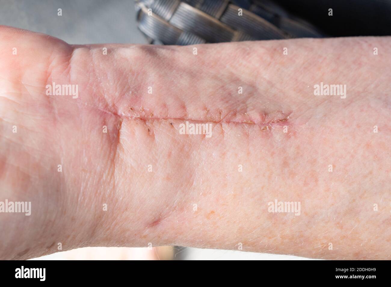 A closeup shot of a scar on a human's wrist Stock Photo - Alamy