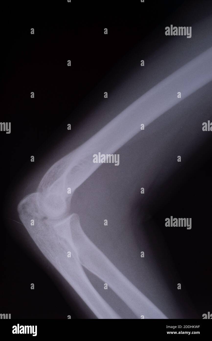 x ray, childs ulna fracture, close up Stock Photo - Alamy