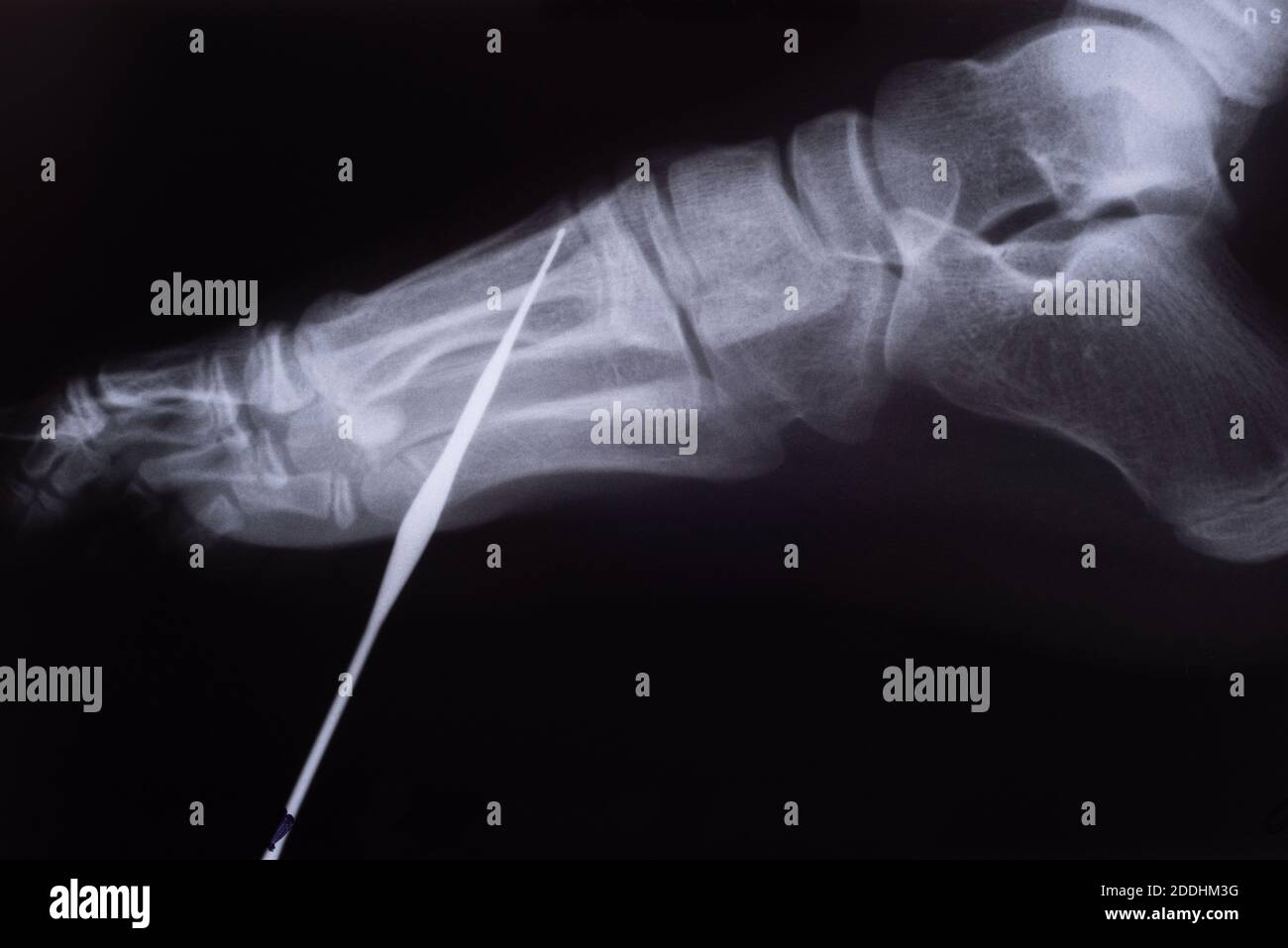 foreign body foot x-ray of a child X-ray radiograph image of a nail ...