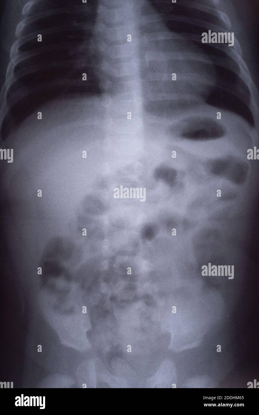 Xray of human bowel constipation hi-res stock photography and images ...