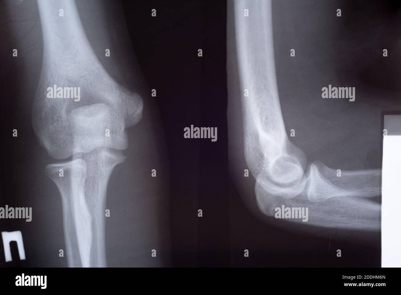 Ulna fracture hi-res stock photography and images - Alamy