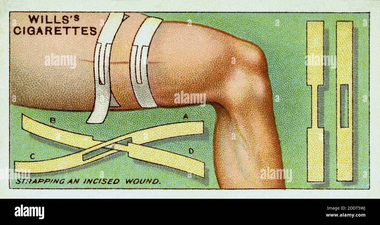 Incised Wound Vs Laceration