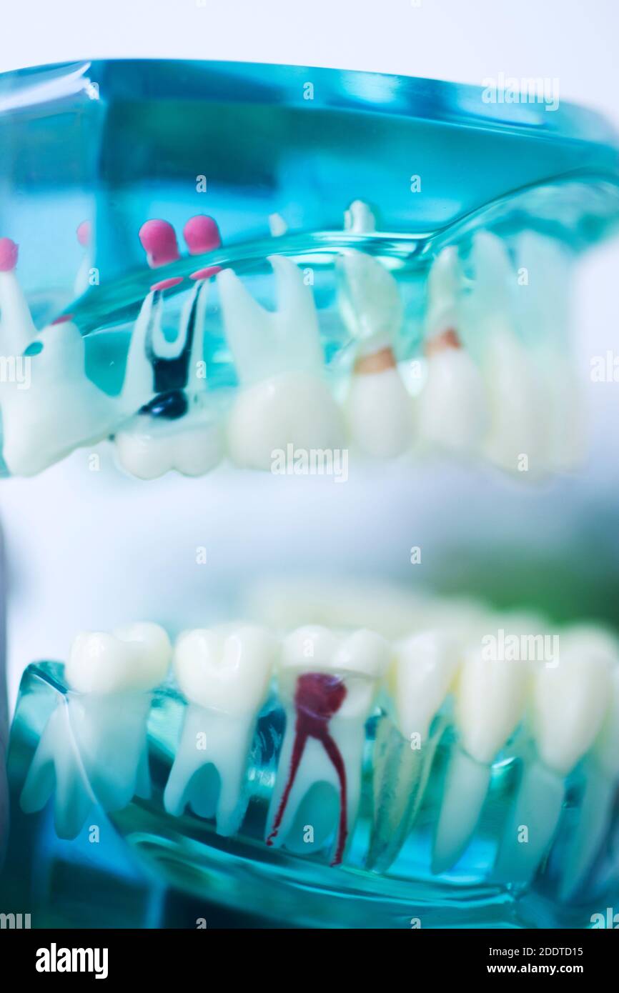 Teeth decay dentistry model showing caries in tooth Stock Photo - Alamy