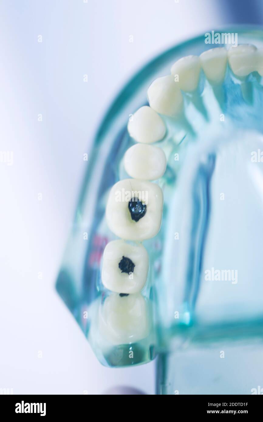 Teeth decay dentistry model showing caries in tooth Stock Photo - Alamy