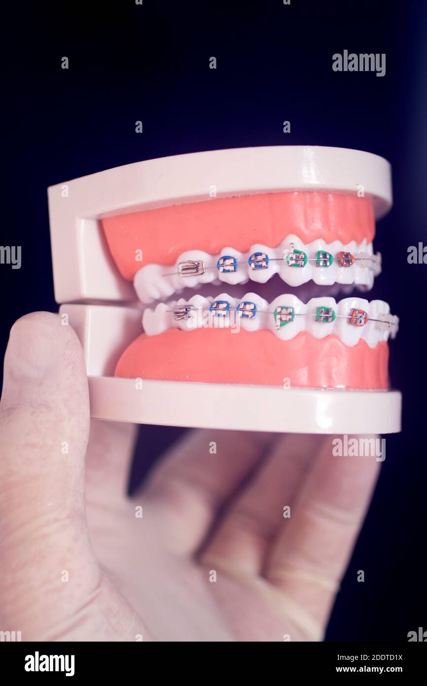 Dental teeth aligner bracket teaching student model showing gums and ...