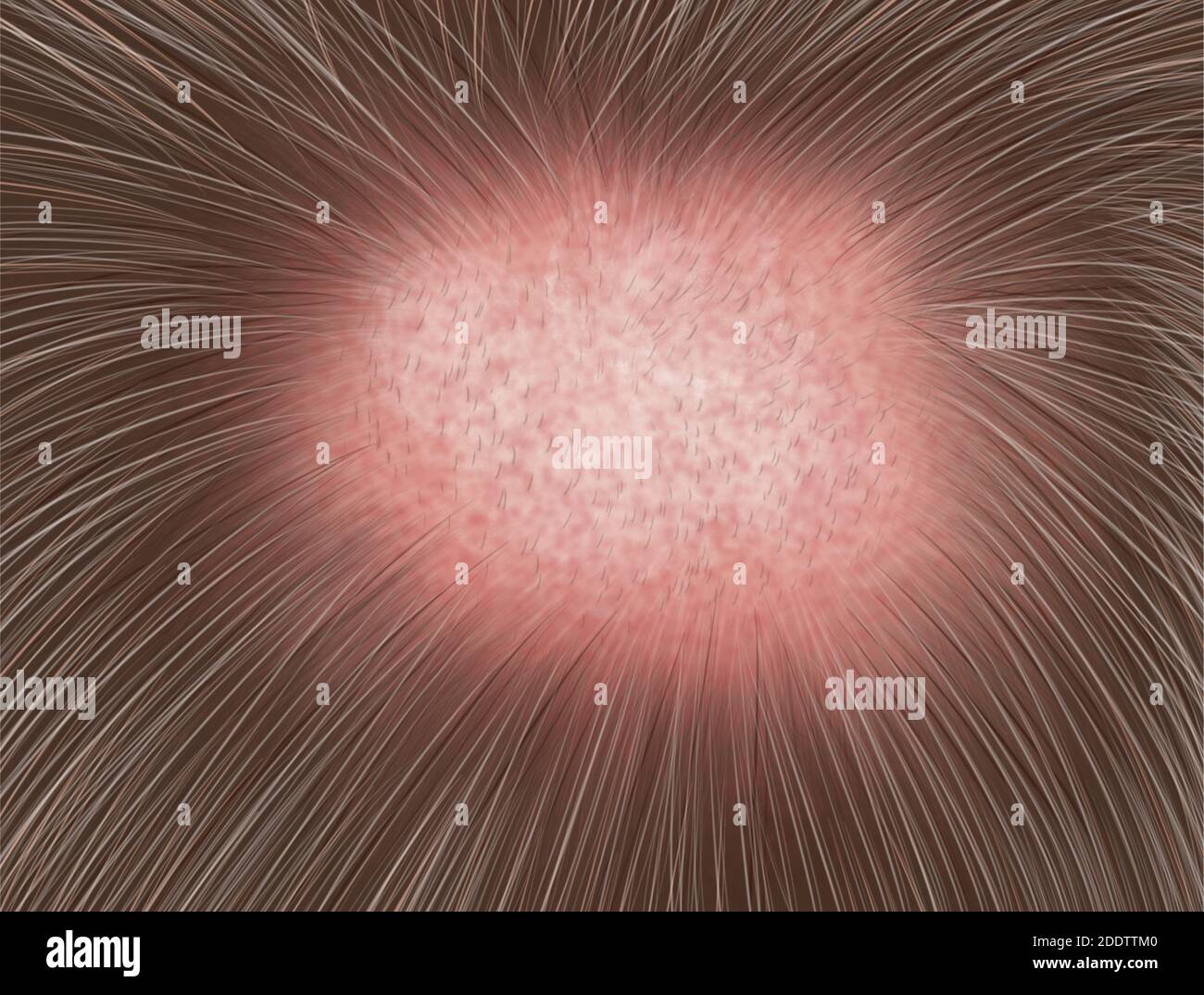 Scabies hand hi-res stock photography and images - Alamy